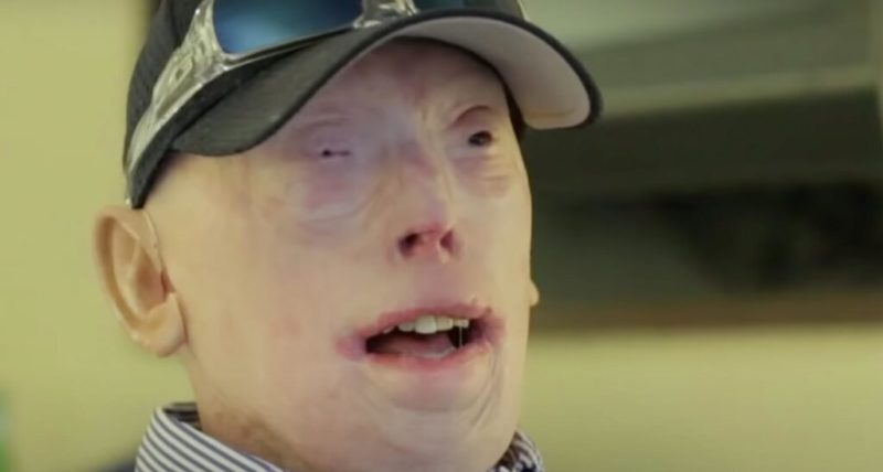 During the assignment, this firefighter burned his entire face. This is ...